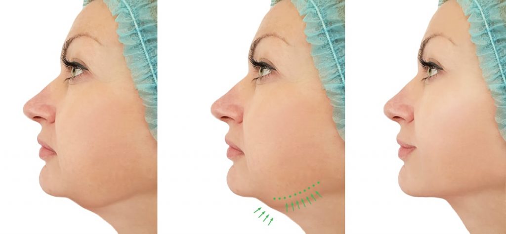 Kybella Cost 2025 - Prices List For Double Chin & Reviews