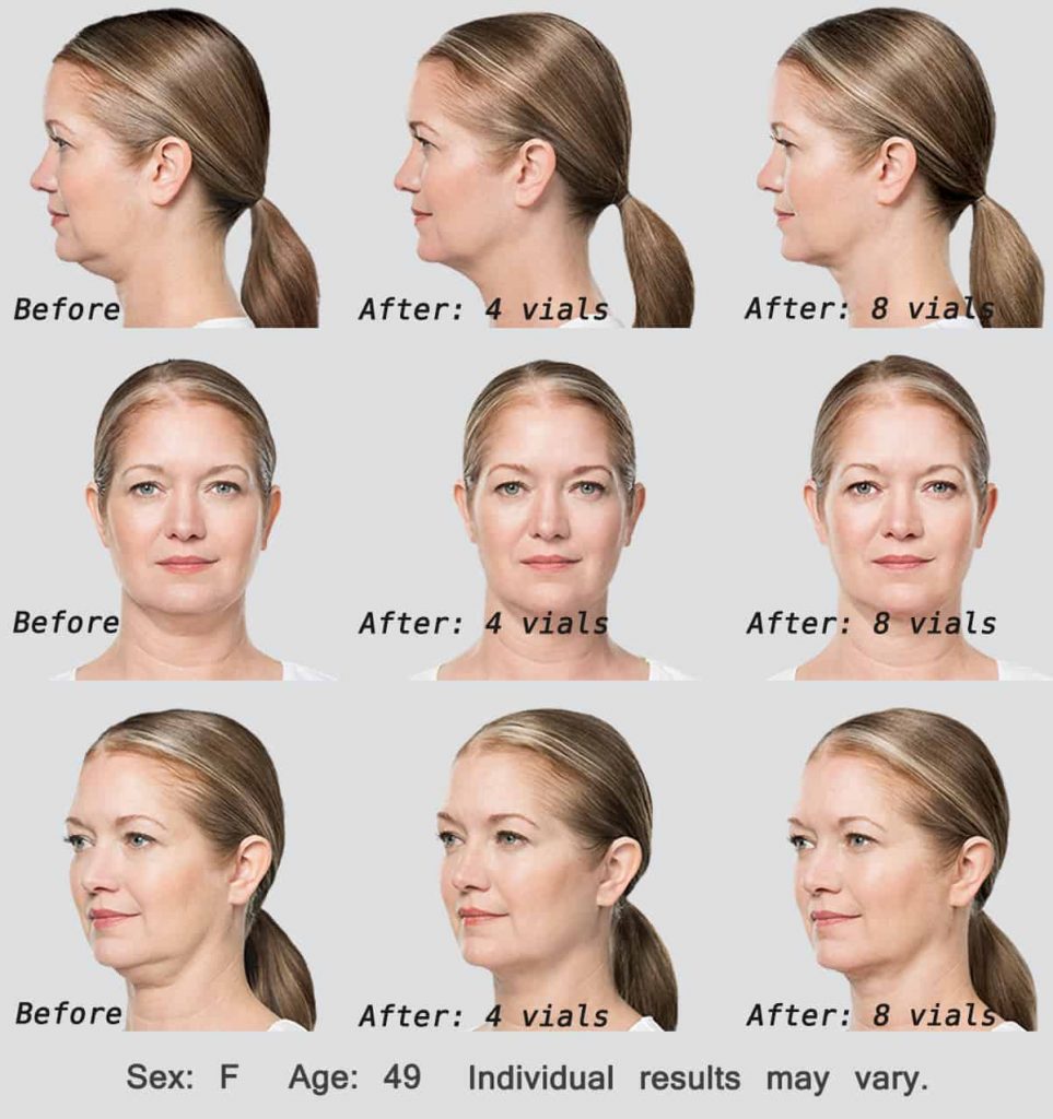 Kybella Cost 2025 - Prices List For Double Chin & Reviews