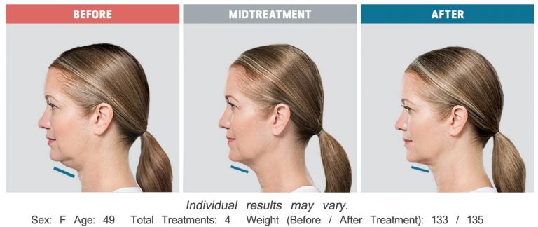 Kybella Cost 2025 - Prices List For Double Chin & Reviews