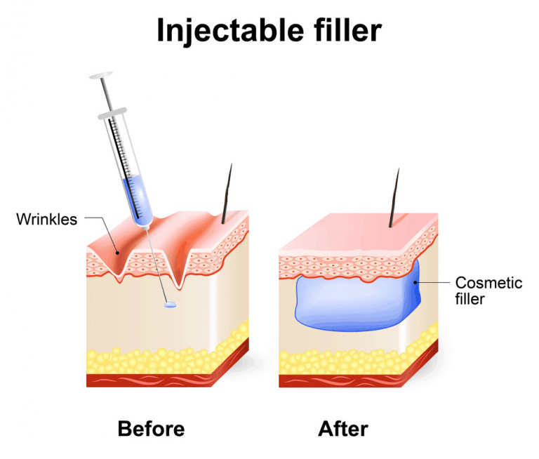 Bellafill Cost 2025: (Artefill) Prices for Under Eyes, Acne Scars ...