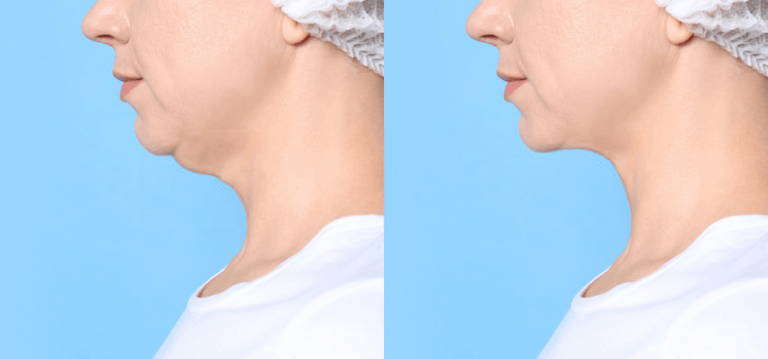 Kybella Cost 2025 - Prices List For Double Chin & Reviews