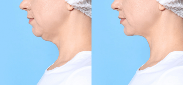 Kybella Cost 2025 - Prices List For Double Chin & Reviews