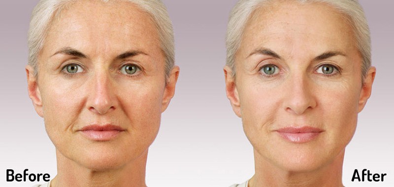 Endermologie Prices Guide 2020 | Endermologie Cost